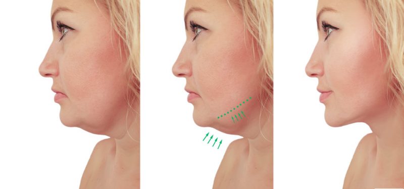 Kybella Injections – Treatment for Double Chin in Kingsport, TN | Eleon ...